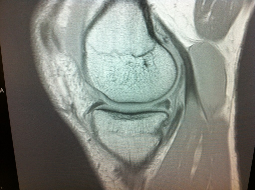 Cadaver Meniscus